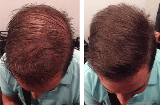 DESCUBRE EL SECRETO DE UNA BARBA Y CABELLO MÁS GRUESO CON DÚO MINÓXIDI ...